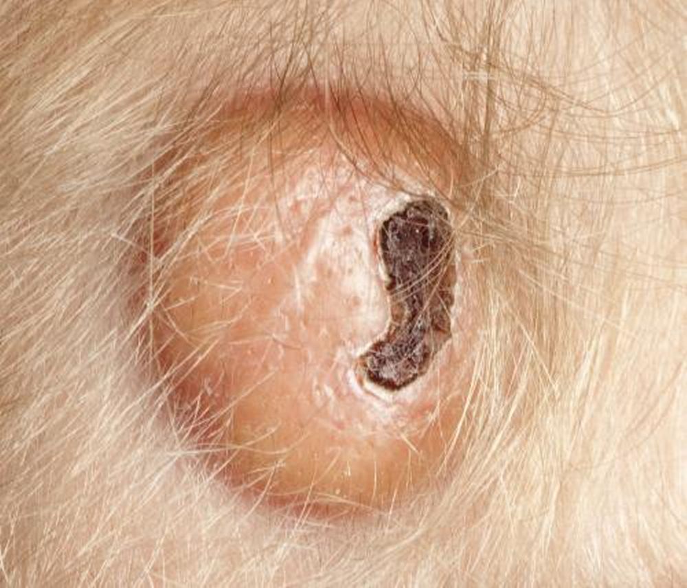 若年性黄色肉芽腫 - 11. 血液学および腫瘍学 - MSDマニュアル プロフェッショナル版