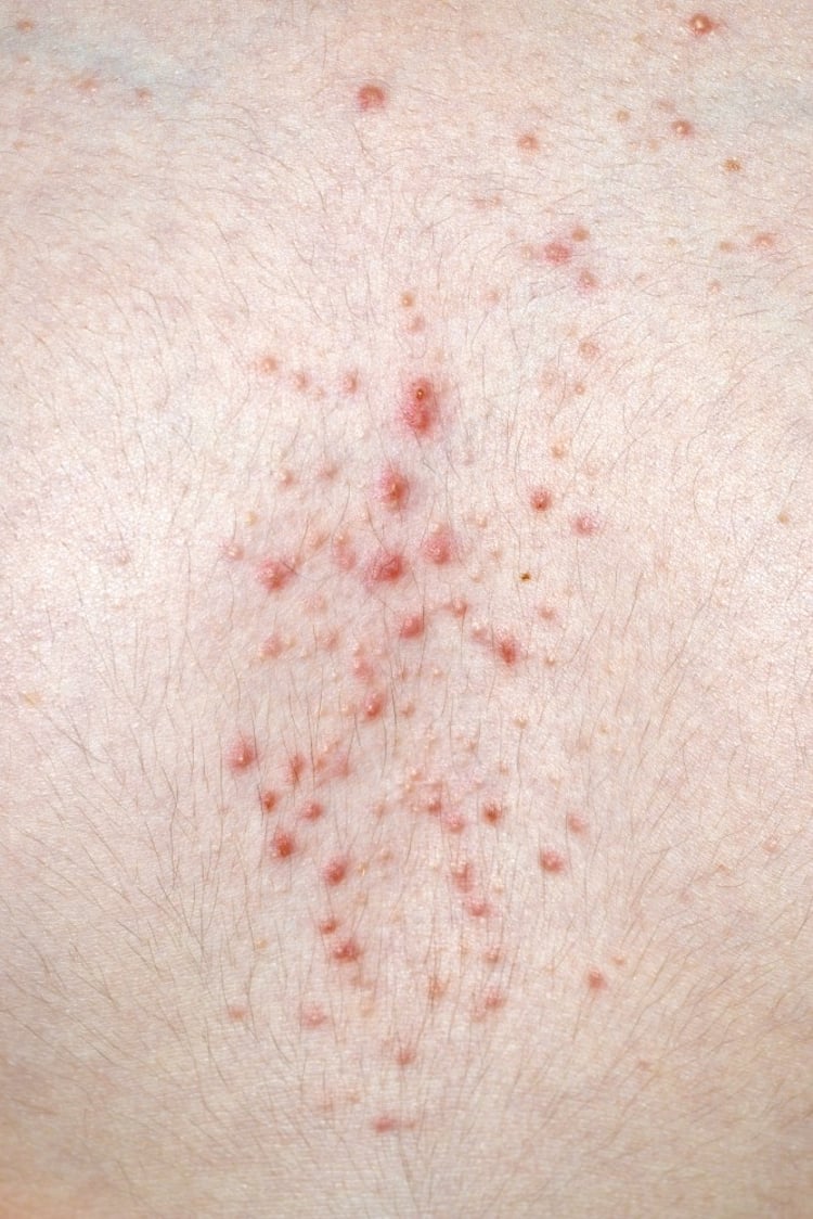 Image:Acneiform Eruption-Merck Manual Professional Edition