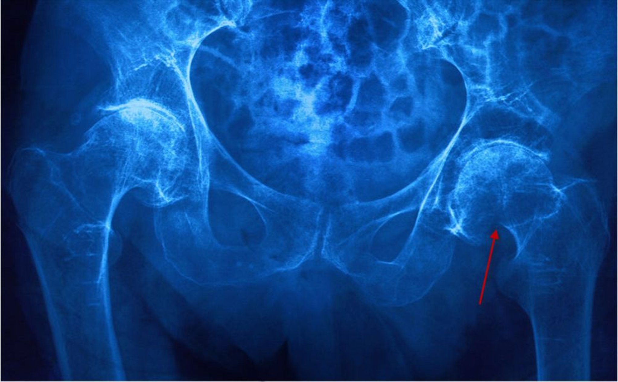 Image:Fracture du col du fémur-Édition professionnelle du Manuel MSD