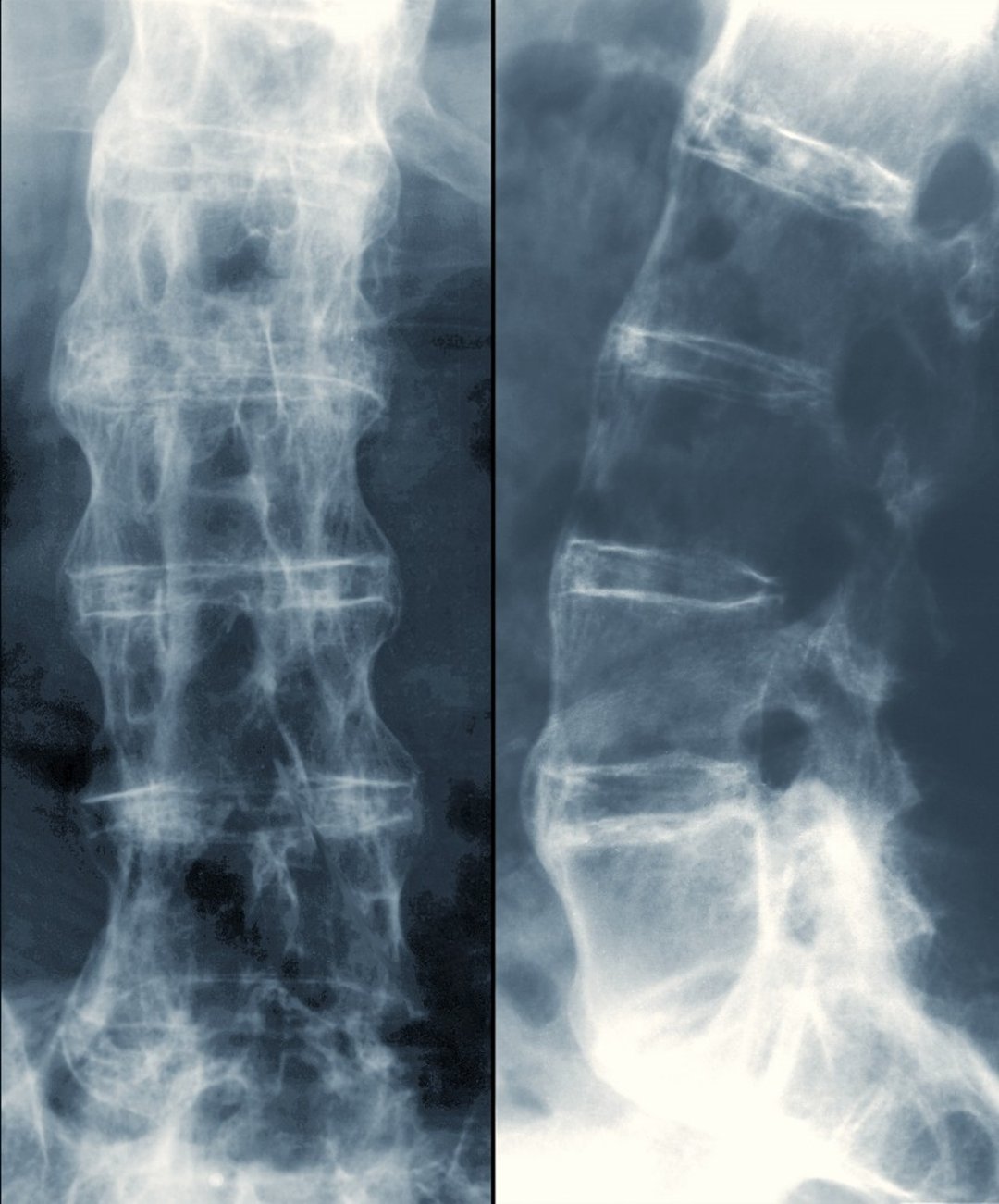 Ankylosing Spondylitis - Musculoskeletal and Connective Tissue ...