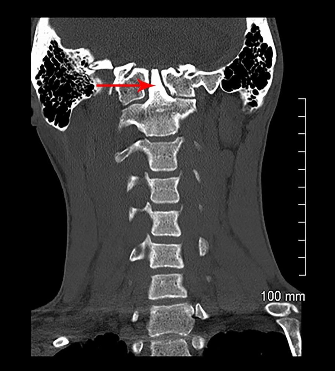 Image:Basilar Invagination and Congenital Assimilation (CT)-MSD Manual ...