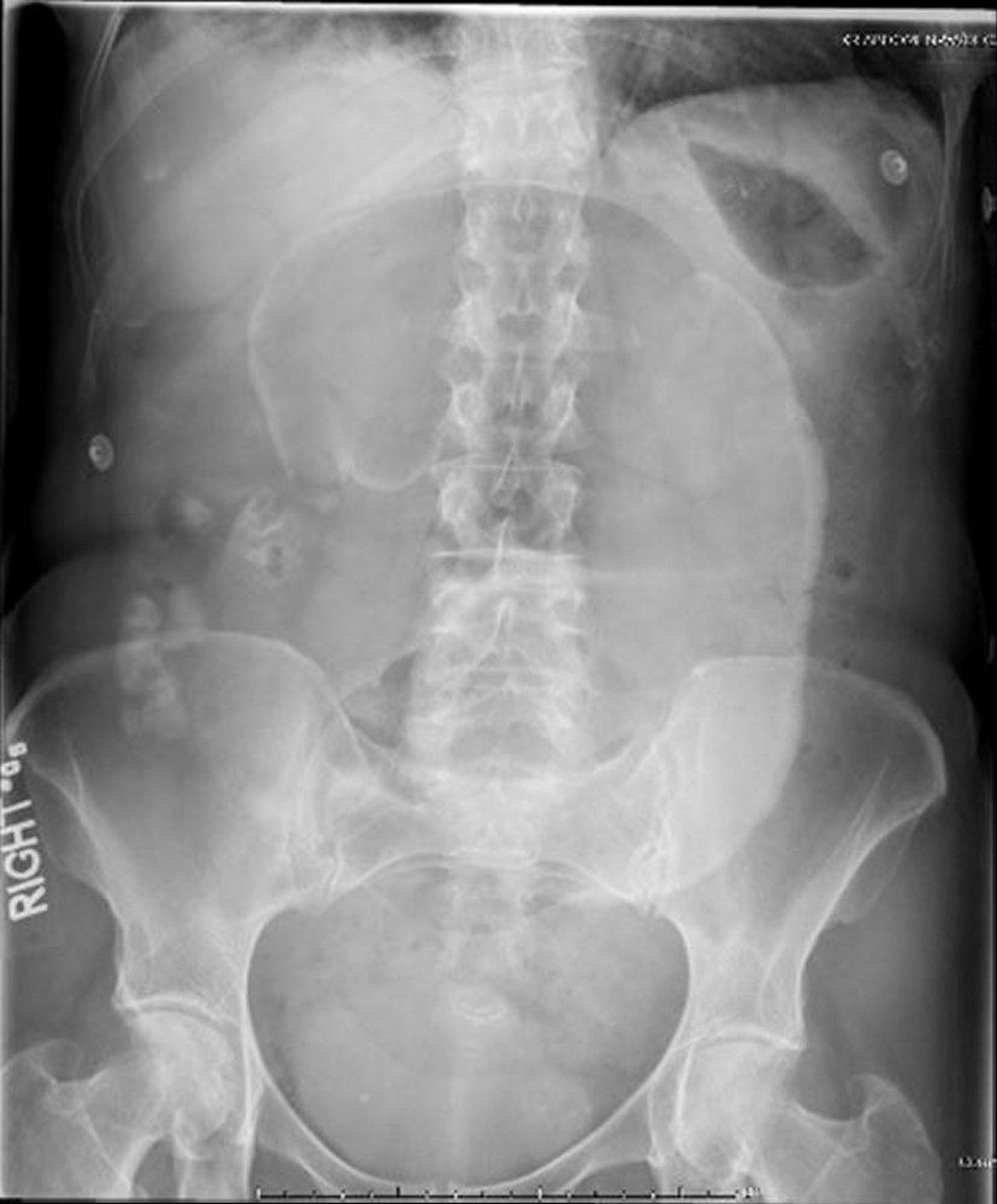 Image:Cecal Volvulus (Abdominal Radiograph)-Merck Manual Professional ...