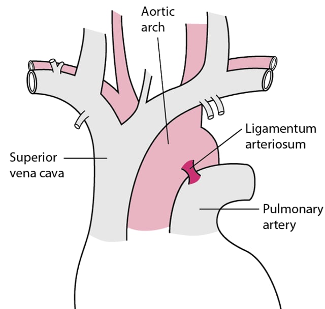 Image:Most Partial Ruptures of the Aorta Occur Near the Ligamentum ...