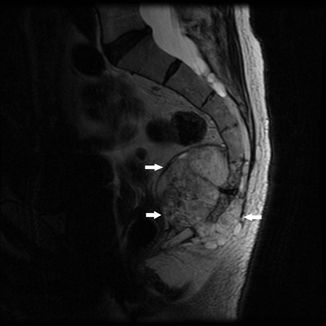 Primary Malignant Bone Tumors - Musculoskeletal and Connective Tissue ...