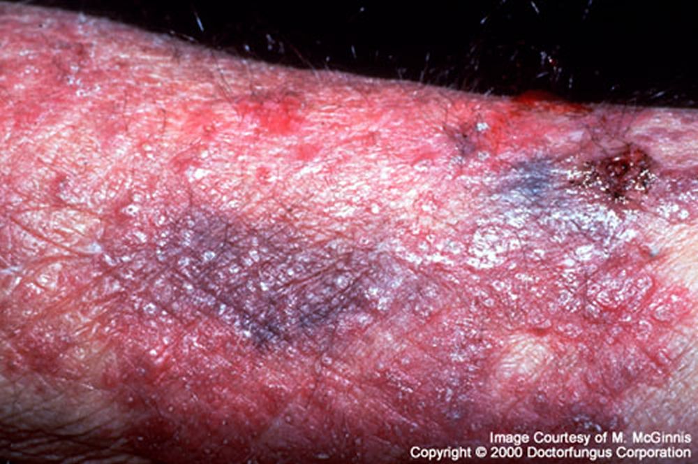 Chromoblastomycosis - Infectious Disease - MSD Manual Professional Edition