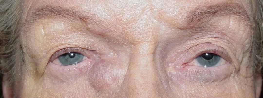 Dacryocystitis - Eye Disorders - Merck Manual Professional Edition