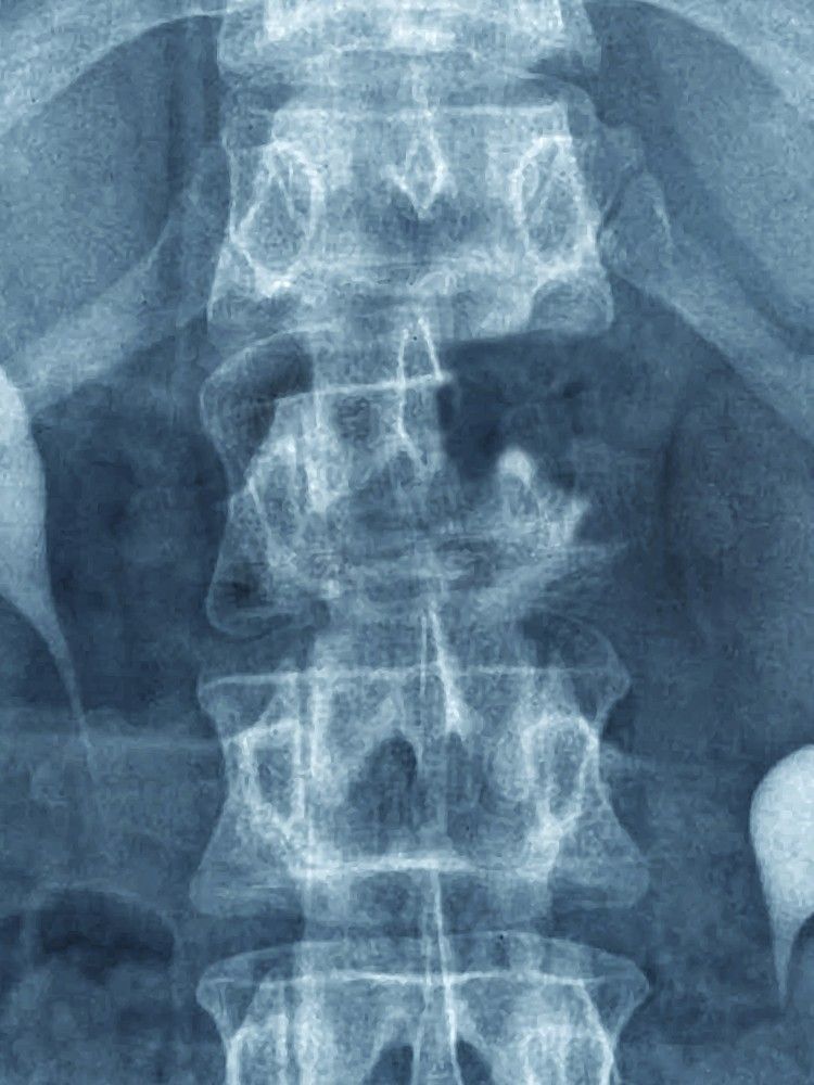 Metastatic Bone Tumors - Musculoskeletal and Connective Tissue ...