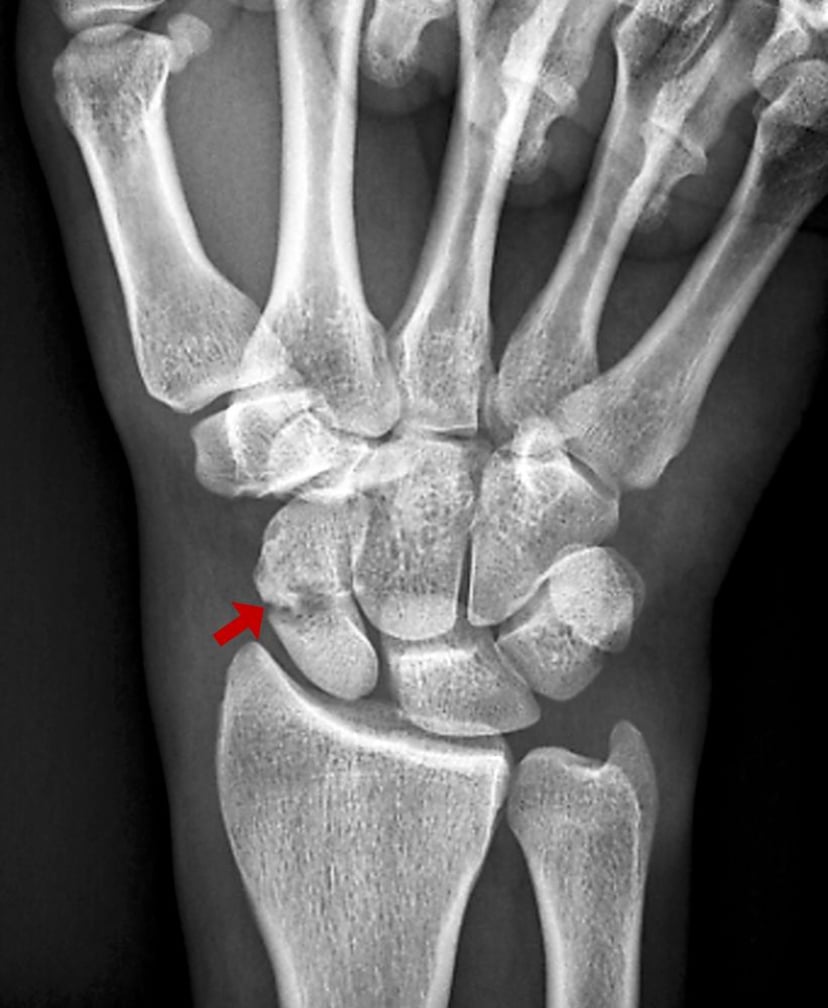 Fracturas del escafoides (navicular) - Lesiones y envenenamientos ...