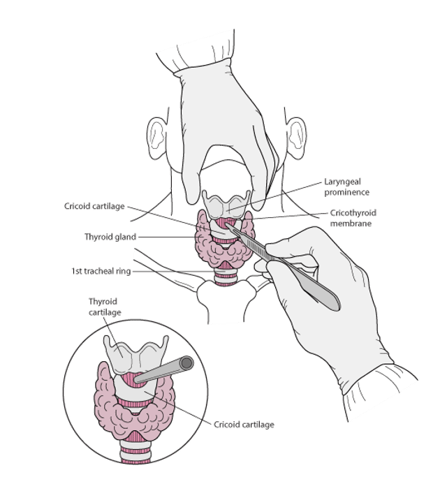 Surgical Airway - Surgical Airway - MSD Manual Professional Edition