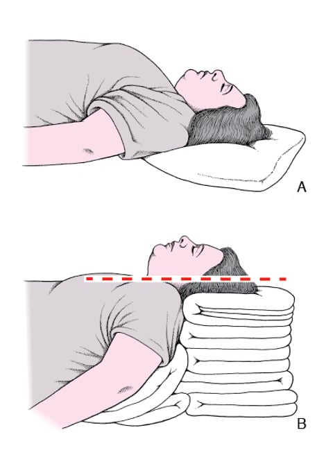 How To Insert an Esophageal-Tracheal Double Lumen Tube or a Laryngeal ...