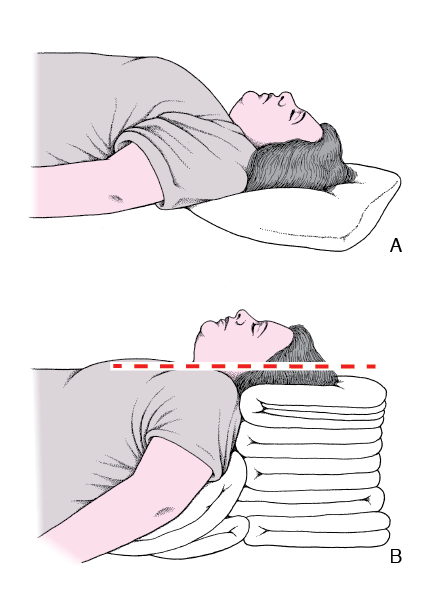 How To Insert an Esophageal-Tracheal Double Lumen Tube or a Laryngeal ...
