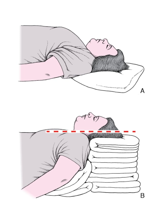 Comment effectuer une intubation orotrachéale sous vidéo-laryngoscopie ...