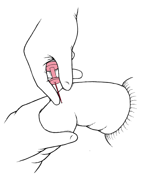How To Place an Intraosseous Catheter, Manually and With a Power Drill ...