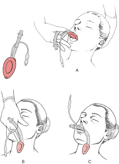 How To Insert a Laryngeal Mask Airway - Critical Care Medicine - Merck Manual Professional Edition