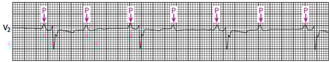 Atrioventricular Block - Cardiovascular Disorders - MSD Manual ...