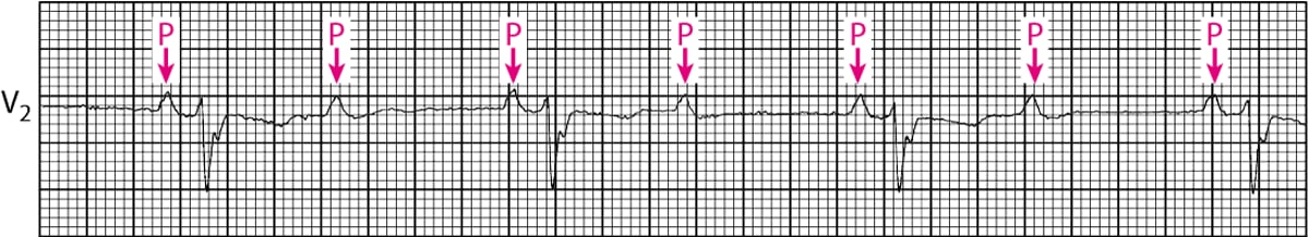 Image:AV-Block II. Grades (hochgradig)-MSD Manual Profi-Ausgabe