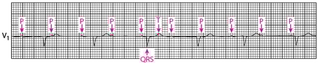 Atrioventricular Block - Cardiovascular Disorders - MSD Manual ...