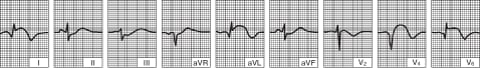 Acute Myocardial Infarction (MI) - Cardiovascular Disorders - MSD ...