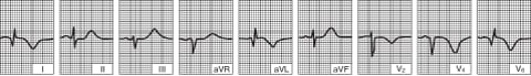Image:Lateral Left Ventricular Infarction (several days later)-Merck ...