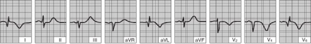 Acute Myocardial Infarction Mi Cardiovascular Disorders Msd