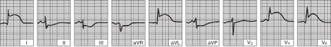 Image:Acute Lateral Left ventricular Infarction (tracing obtained ...