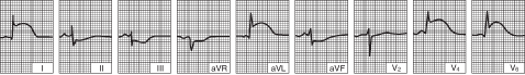 Acute Myocardial Infarction (MI) - Cardiology - MSD Manual Professional ...