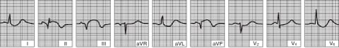 Image:Inferior (Diaphragmatic) Left Ventricular Infarction (after the ...