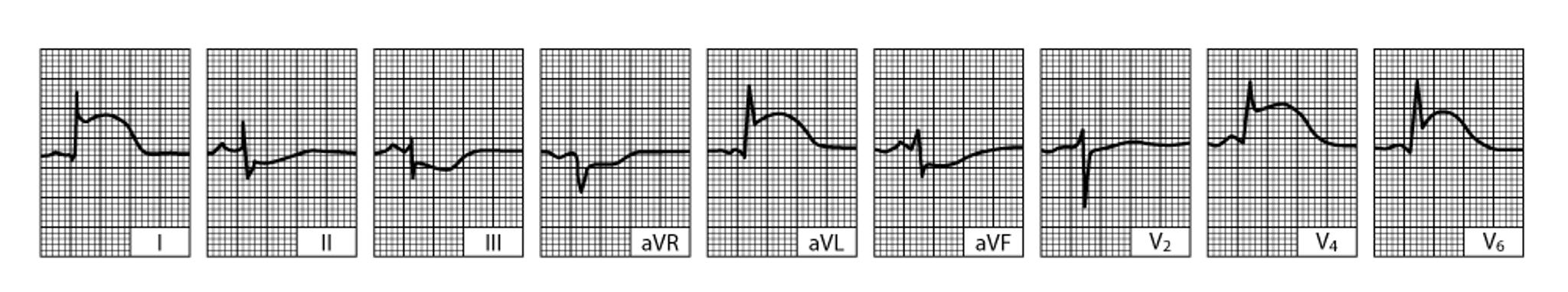 Image:Infarctus latéral aigu du ventricule gauche (tracé obtenu ...