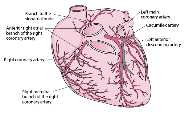 Overview of Coronary Artery Disease - Cardiovascular Disorders - MSD Manual Professional Edition