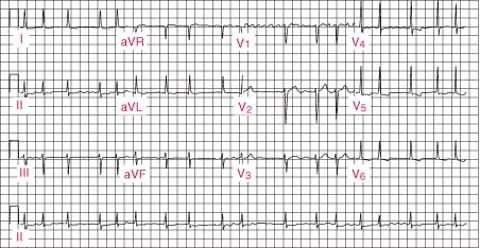 Atrial Fibrillation - Cardiovascular Disorders - MSD Manual ...