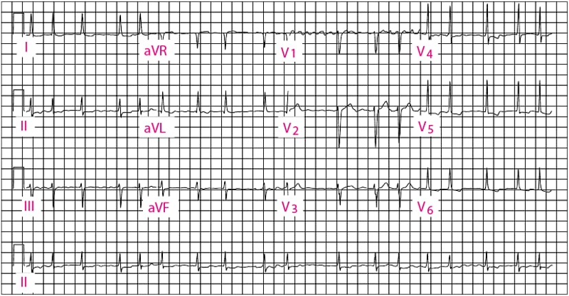 Vorhofflimmern - Herz-Kreislauf-Krankheiten - MSD Manual Profi-Ausgabe