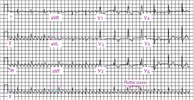 Atrial Flutter - Cardiovascular Disorders - Merck Manual Professional ...