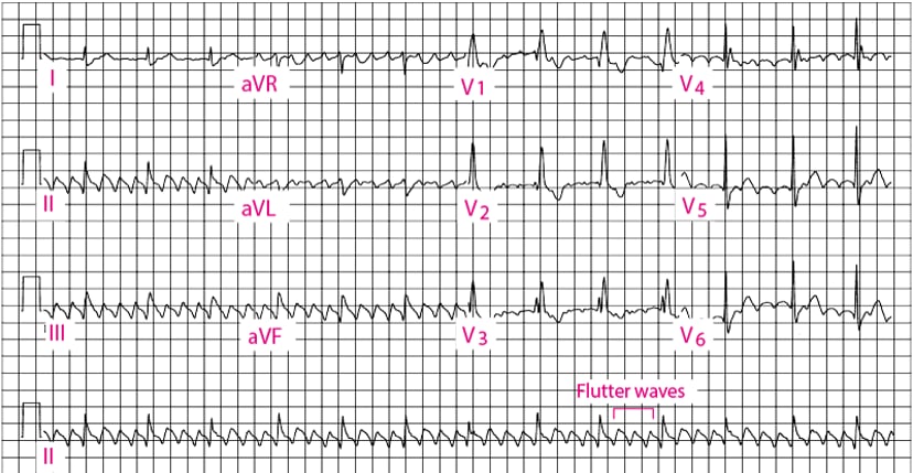 Vorhofflattern - Herz-Kreislauf-Krankheiten - MSD Manual Profi-Ausgabe