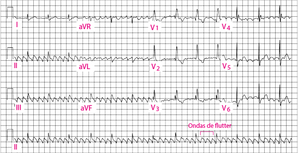 Flutter atrial - Doenças cardiovasculares - Manuais MSD edição para ...