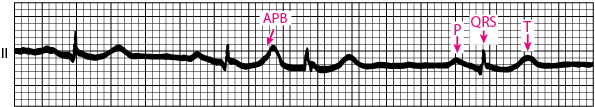 Ectopic Supraventricular Arrhythmias - Cardiology - MSD Manual ...