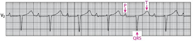 Atrioventricular Block - Cardiovascular Disorders - MSD Manual ...