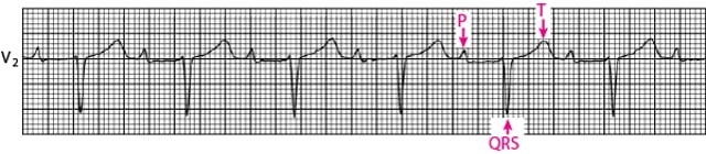 Image:Bloqueio atrioventricular de primeiro grau-Manuais MSD edição ... Image:Bloqueio atrioventricular de primeiro grau-Manuais MSD edição ...