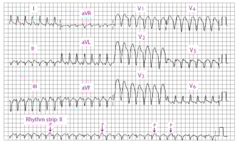 Ventricular Tachycardia (VT) - Cardiovascular Disorders - Merck Manual ...
