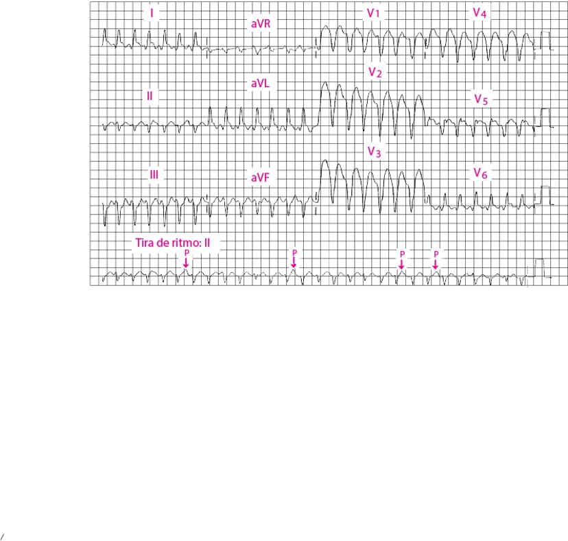 Image:Taquicardia ventricular con complejo QRS ancho-Manual MSD versión ...