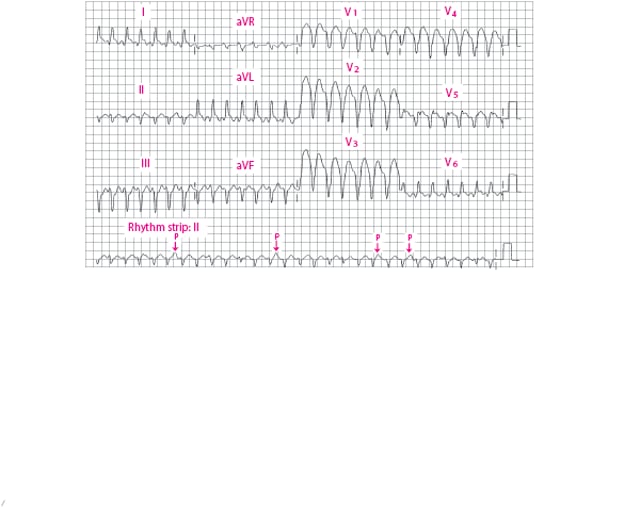 室性心动过速（VT） - 室性心动过速（VT） - MSD诊疗手册专业版