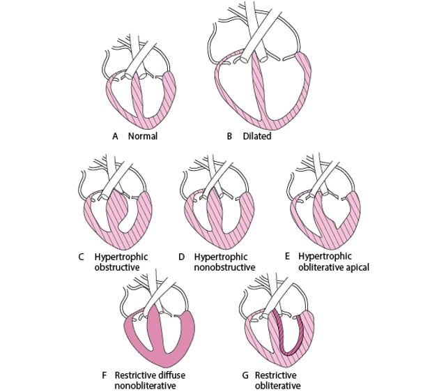 Overview of Cardiomyopathies - Cardiovascular Disorders - Merck Manual ...