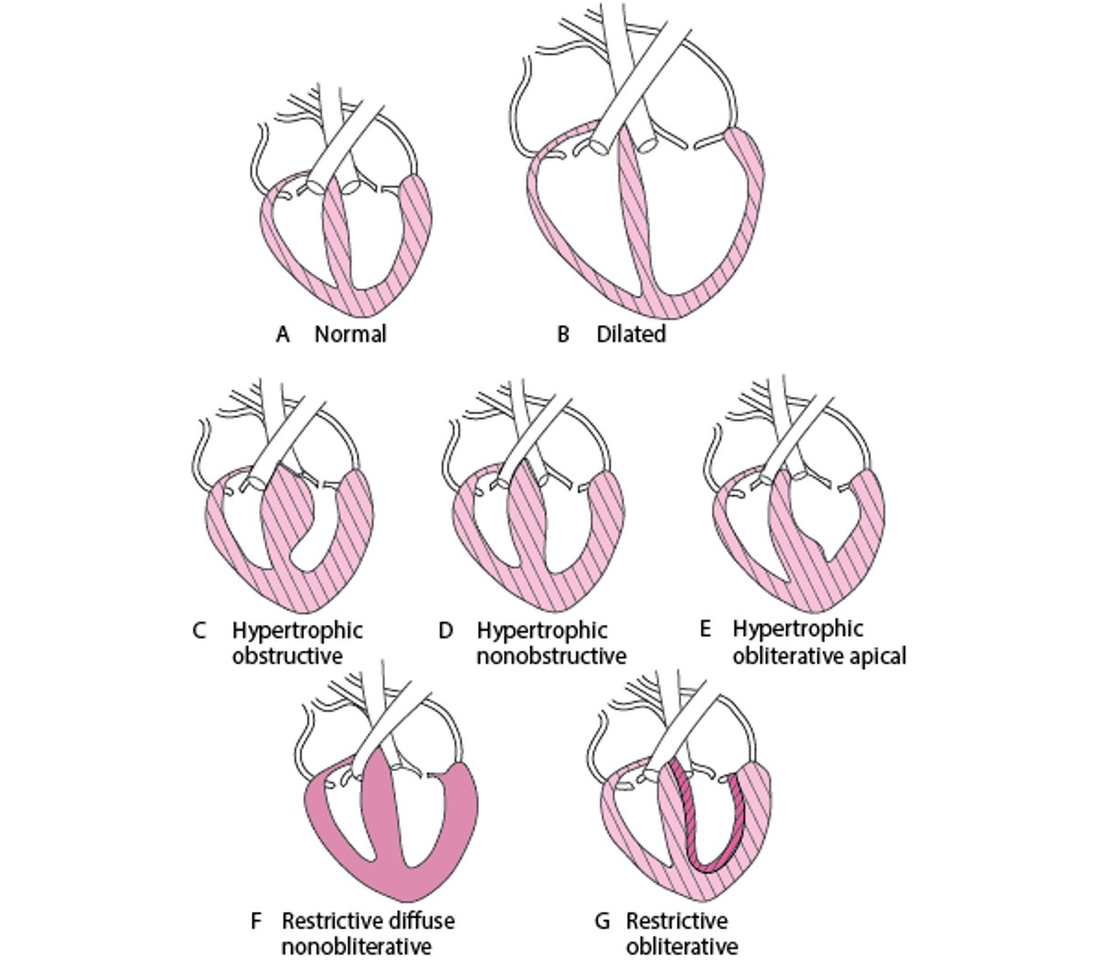 Image Forms Of Cardiomyopathy Merck Manual Professional Edition