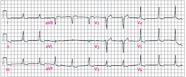 Wolff-Parkinson-White Syndrome (WPW Syndrome) - Cardiovascular ...