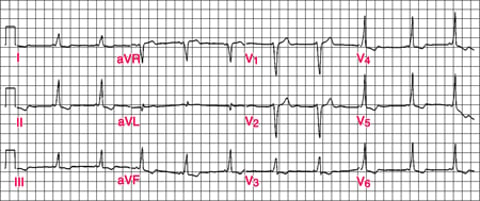Hội chứng Wolff-Parkinson-White (Hội chứng WPW) - Rối loạn tim mạch ...