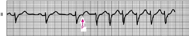 Overview of Arrhythmias - Cardiovascular Disorders - MSD Manual ...
