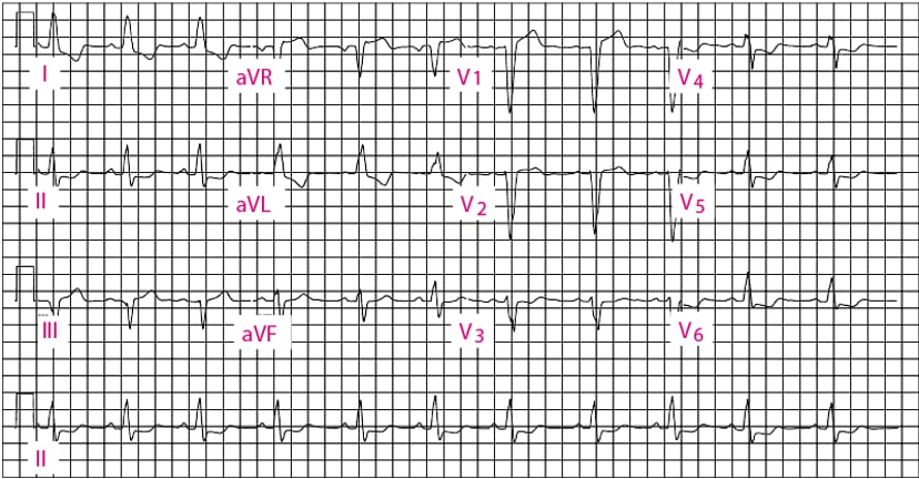 Schenkelblock und Hemiblock (Faszikelblock) - Herz-Kreislauf ...