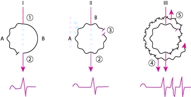 Image:Mecanismo de reentrada típico-Manual MSD versión para profesionales