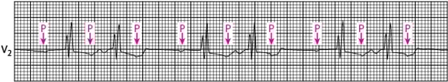 Image:Mobitz type II second-degree atrioventricular block-MSD Manual ...