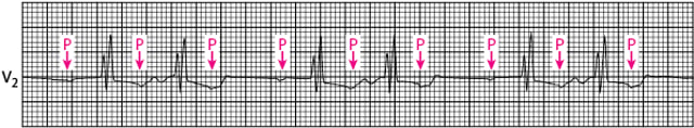 Image:Mobitz type II second-degree atrioventricular block-Merck Manual ...