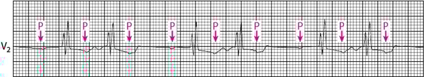 Image:AV-Block II. Grades Typ 2-MSD Manual Profi-Ausgabe